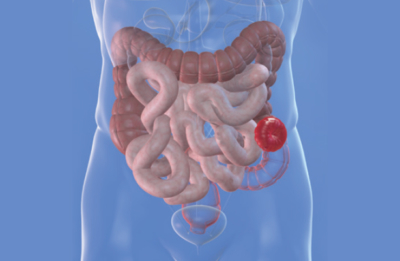 Cuidado de su colostomía - Igrobe